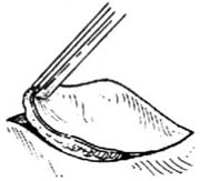 Talg cyste eksisie - Bladsye [1] - Wêreld ensiklopediese kennis