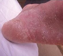 Atleet se voet - Bladsye [1] - Wêreld ensiklopediese kennis