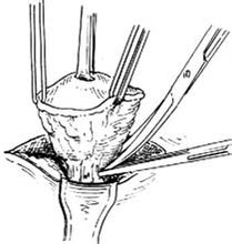 Talg cyste eksisie - Bladsye [1] - Wêreld ensiklopediese kennis