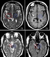 Verlamming - Bladsye [1] - Wêreld ensiklopediese kennis